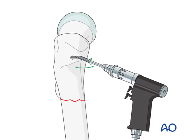 ORIF - Bridge plating (blade plate) for Simple, transverse, proximal 1/ ...