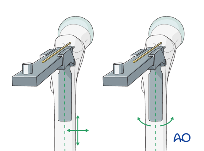 ORIF - Bridge plating (blade plate) for Simple, transverse, proximal 1/ ...