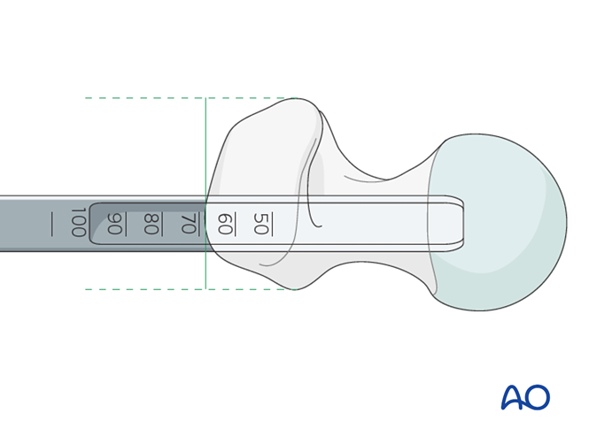 ORIF - Bridge plating (blade plate) for Simple, transverse, proximal 1/ ...