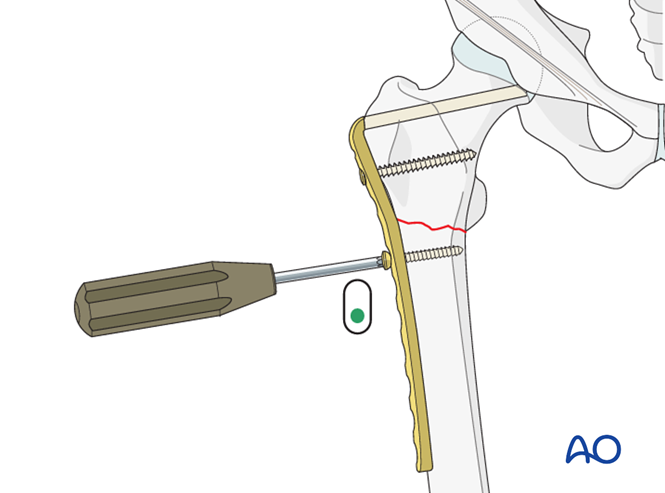 ORIF - Bridge plating (blade plate) for Simple, transverse, proximal 1/ ...