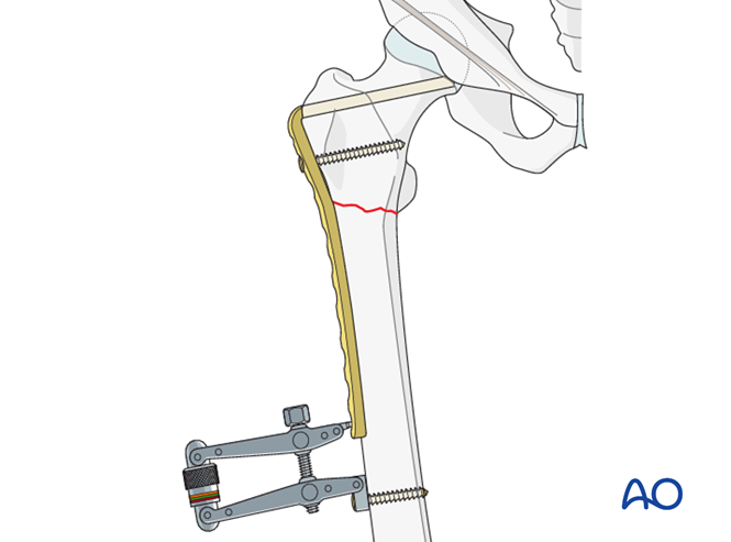 ORIF - Bridge plating (blade plate) for Simple, transverse, proximal 1/ ...
