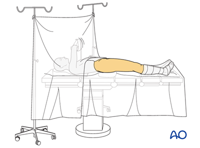 Supine with manual traction