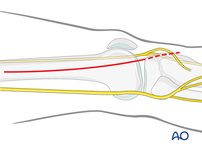 Lateral/anterolateral approach to the distal femur