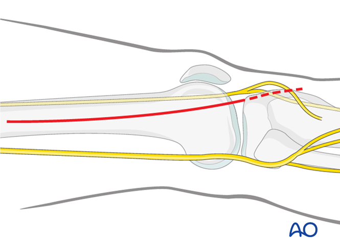 Lateral/anterolateral approach to the distal femur