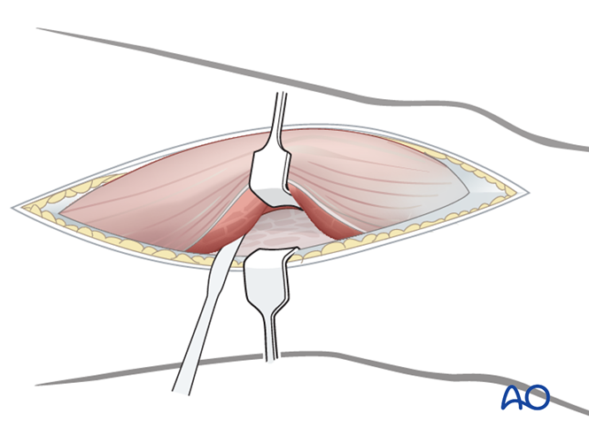 Lateral/anterolateral approach to the distal femur