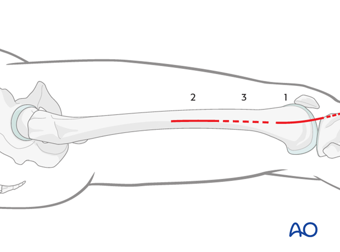 MIO - dynamic condylar screw system (DCS)