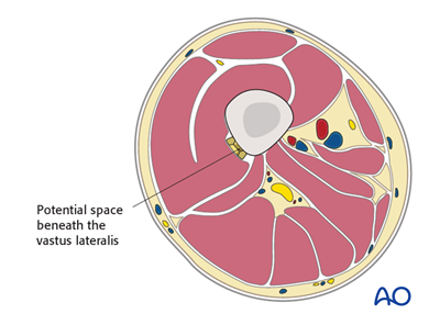 MIPO approach to the distal femur from lateral/anterolateral