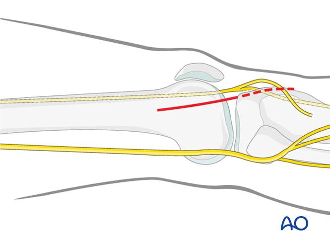 MIPO approach to the distal femur from lateral/anterolateral