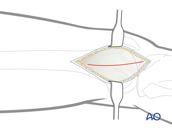 MIPO approach to the distal femur from lateral/anterolateral