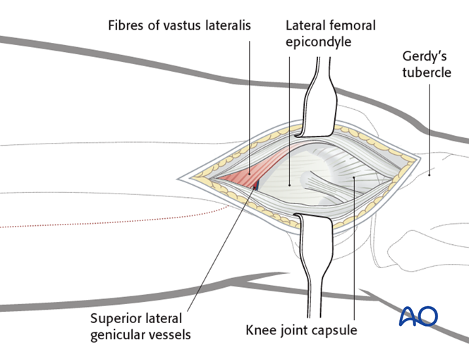 MIPO approach to the distal femur from lateral/anterolateral
