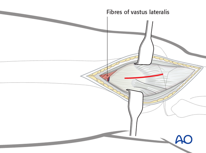 MIPO approach to the distal femur from lateral/anterolateral