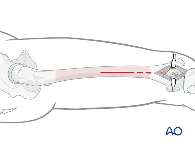 Lateral parapatellar approach to the distal femur