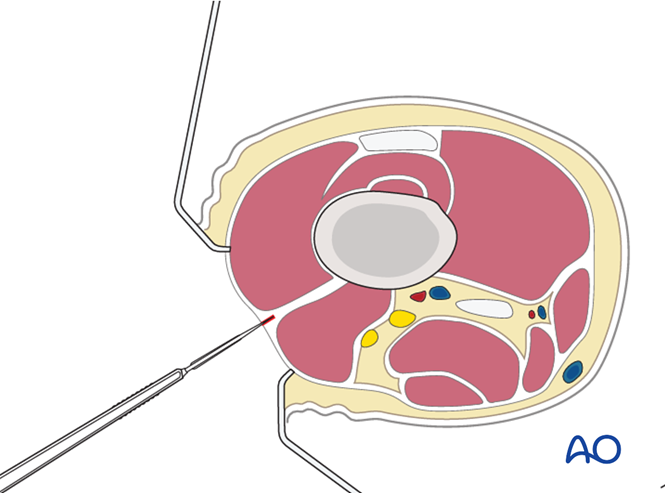 MIPO approach to the distal femur from lateral/anterolateral