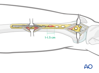 Lateral parapatellar approach to the distal femur