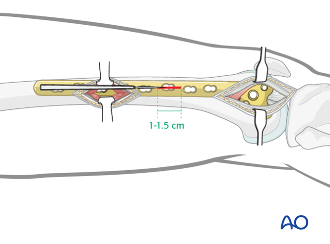 Lateral parapatellar approach to the distal femur
