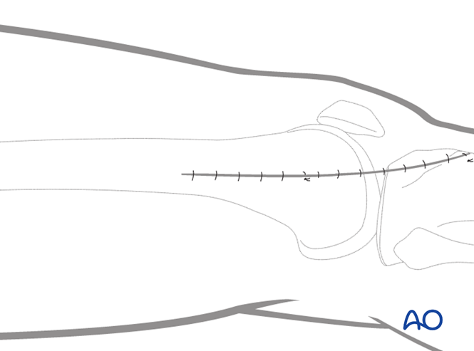 MIPO approach to the distal femur from lateral/anterolateral