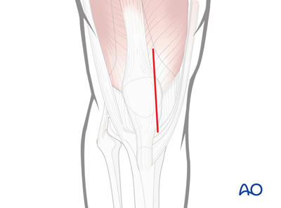 Medial parapatellar approach to the distal femur