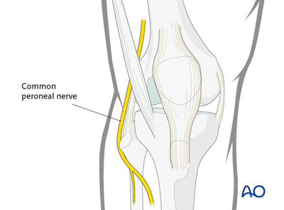 Lateral parapatellar approach to the distal femur