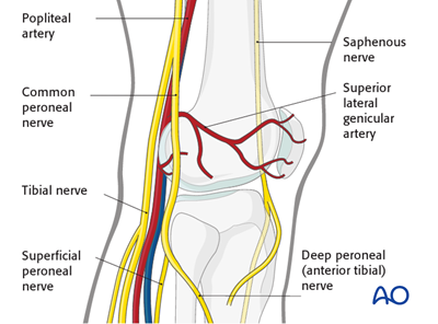 Lateral parapatellar approach to the distal femur