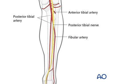 Safe zones in the femur for pin insertion