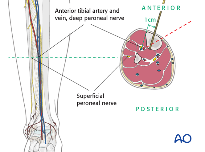 Safe zones in the femur for pin insertion