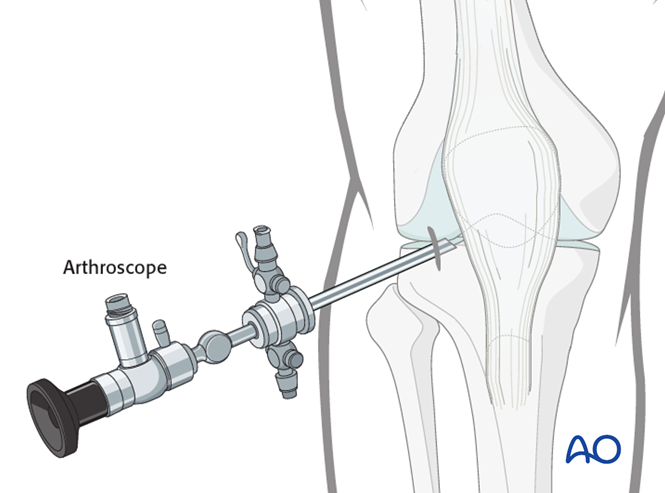 Arthroscopic approach to the knee