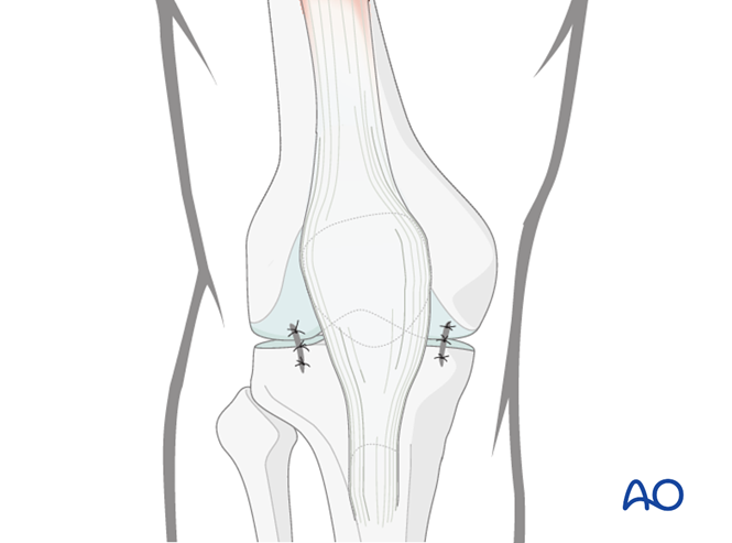 Arthroscopic approach to the knee