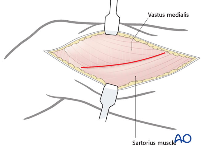 Medial approach to the distal femur