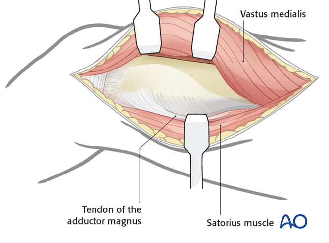 Medial approach to the distal femur