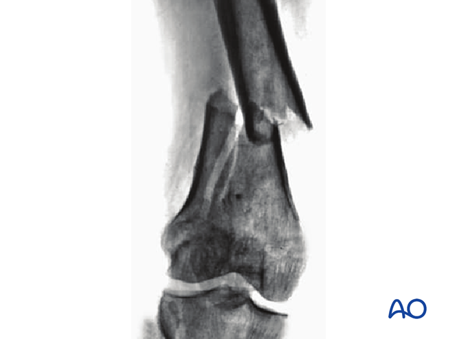 Extraarticular fracture, wedge