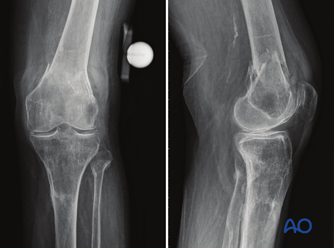 Extraarticular fracture, wedge