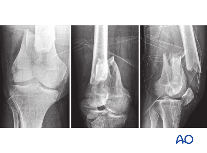 Complete articular fracture, simple articular, intact or fragmentary ...