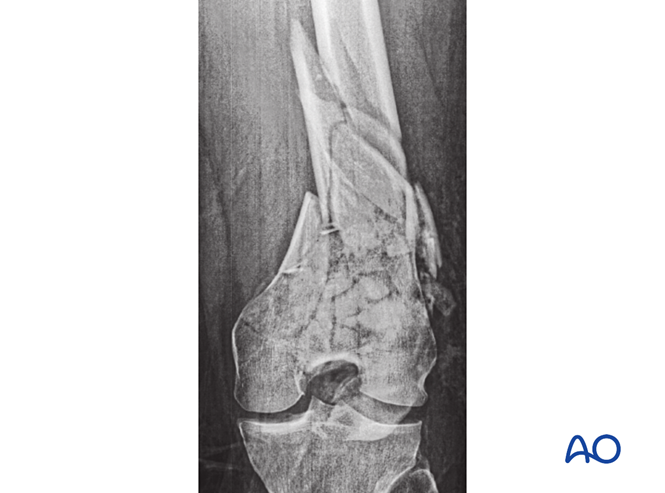 Complete articular fracture, multifragmentary articular ...