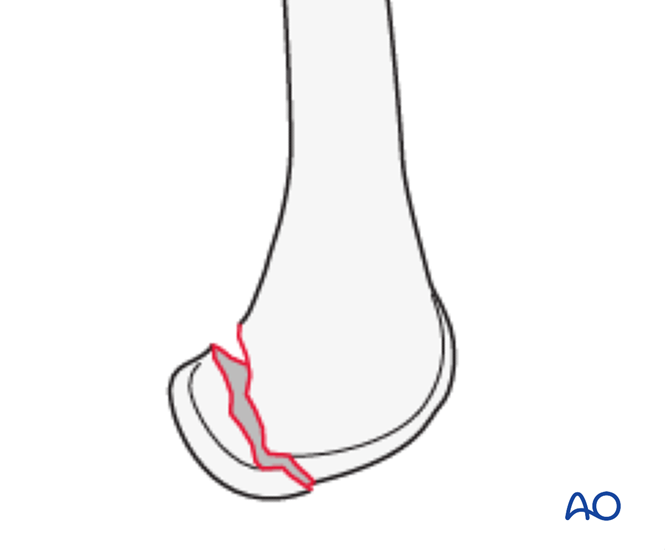Partial articular fracture, frontal/coronal, posterior condyle(s)
