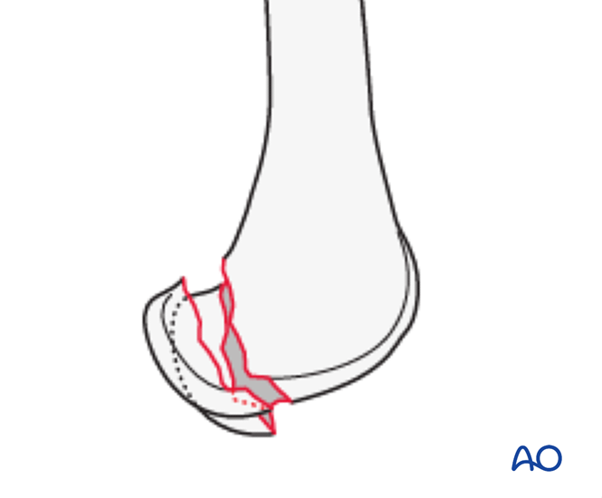 Partial articular fracture, frontal/coronal, posterior condyle(s)