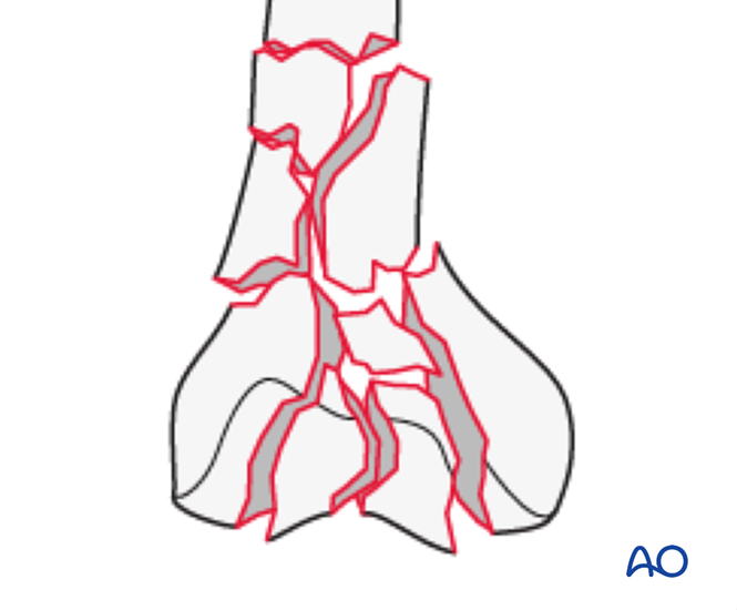 Complete articular fracture, multifragmentary articular ...
