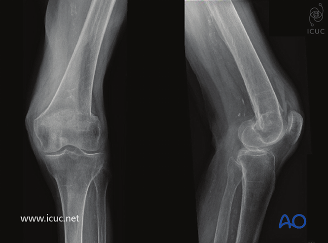 MIO - less invasive stabilization system (LISS)