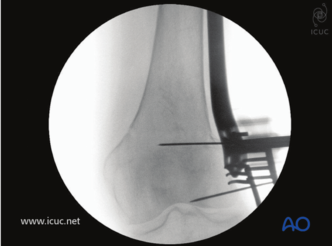 MIO - less invasive stabilization system (LISS)