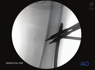 MIO - less invasive stabilization system (LISS)