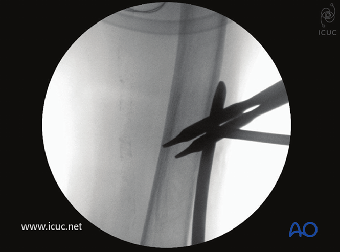 MIO - less invasive stabilization system (LISS)