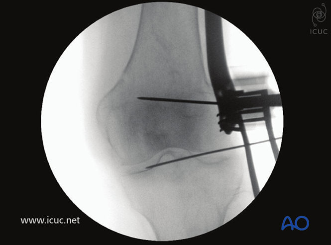 MIO - less invasive stabilization system (LISS)