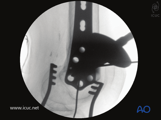 MIO - less invasive stabilization system (LISS)