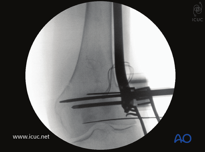 MIO - less invasive stabilization system (LISS)