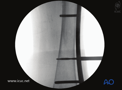 MIO - less invasive stabilization system (LISS)