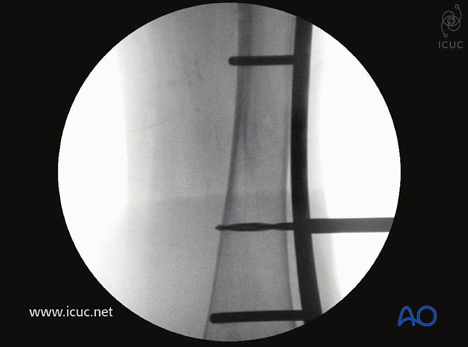 MIO - less invasive stabilization system (LISS)