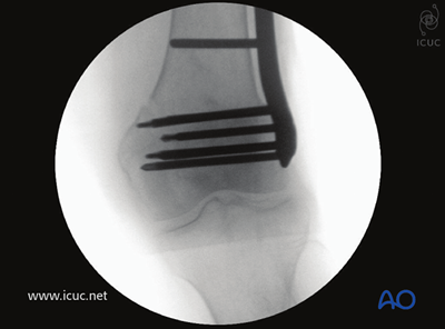 MIO - less invasive stabilization system (LISS)