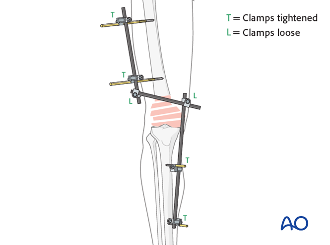 Temporary external fixator for Extraarticular fracture, wedge