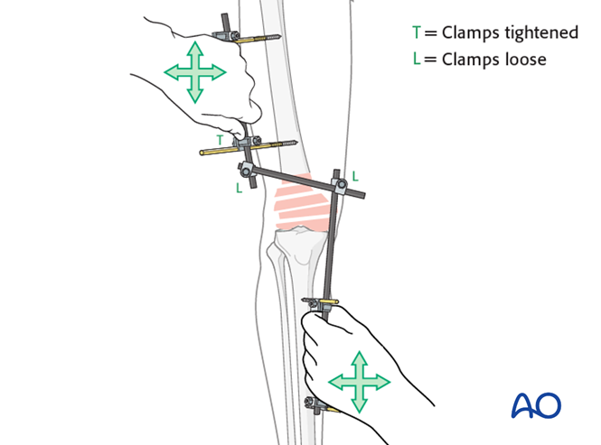 Traction for Complete articular fracture, multifragmentary articular ...