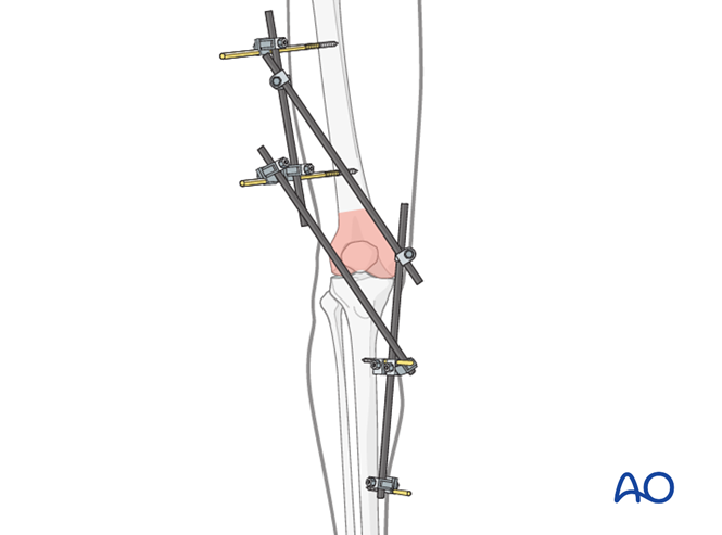 Temporary external fixator for Extraarticular fracture, wedge