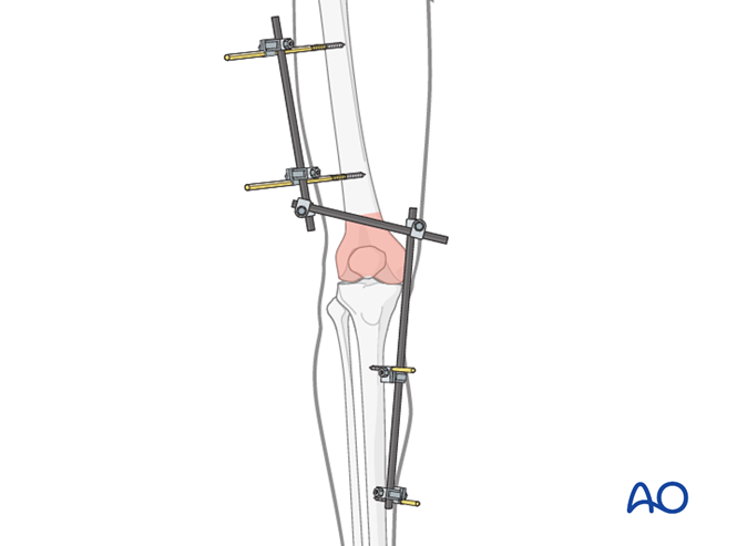 Temporary external fixator for Extraarticular fracture, simple